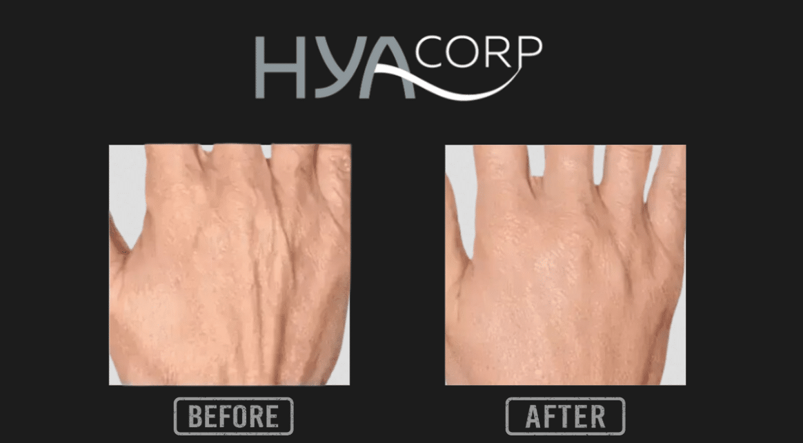 HYAcorp Before & After | Med Supply Solutions