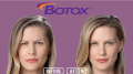 Botox Mechanism of Action | Med Supply Solutions